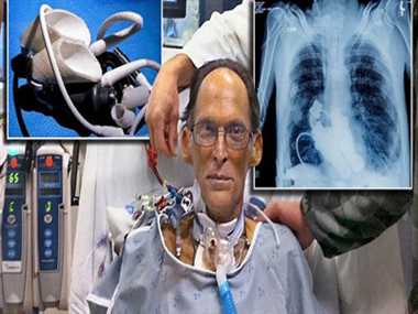 दुनिया में बिना दिल का पहला आदमी - The first person in the world ...