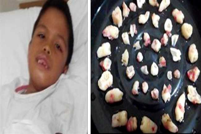 OMG! इस 9 साल के बच्चे के हैं 300 दांत