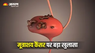 सर्जरी के बाद रेडिएशन थेरेपी से आधा हो जाता है Bladder Cancer का खतरा ...