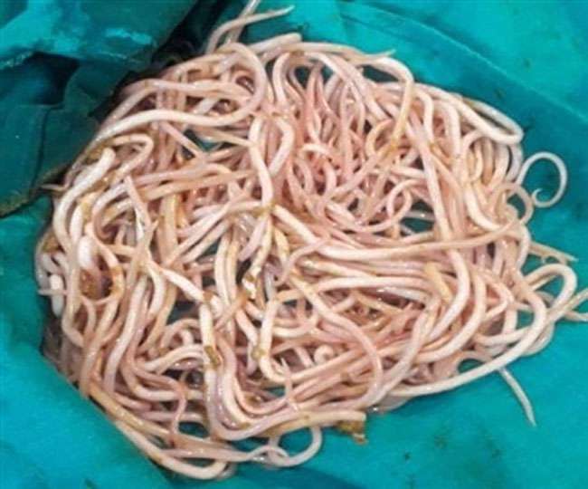 महिला के पेट में 300 कीड़ों ने बना रखा था घर