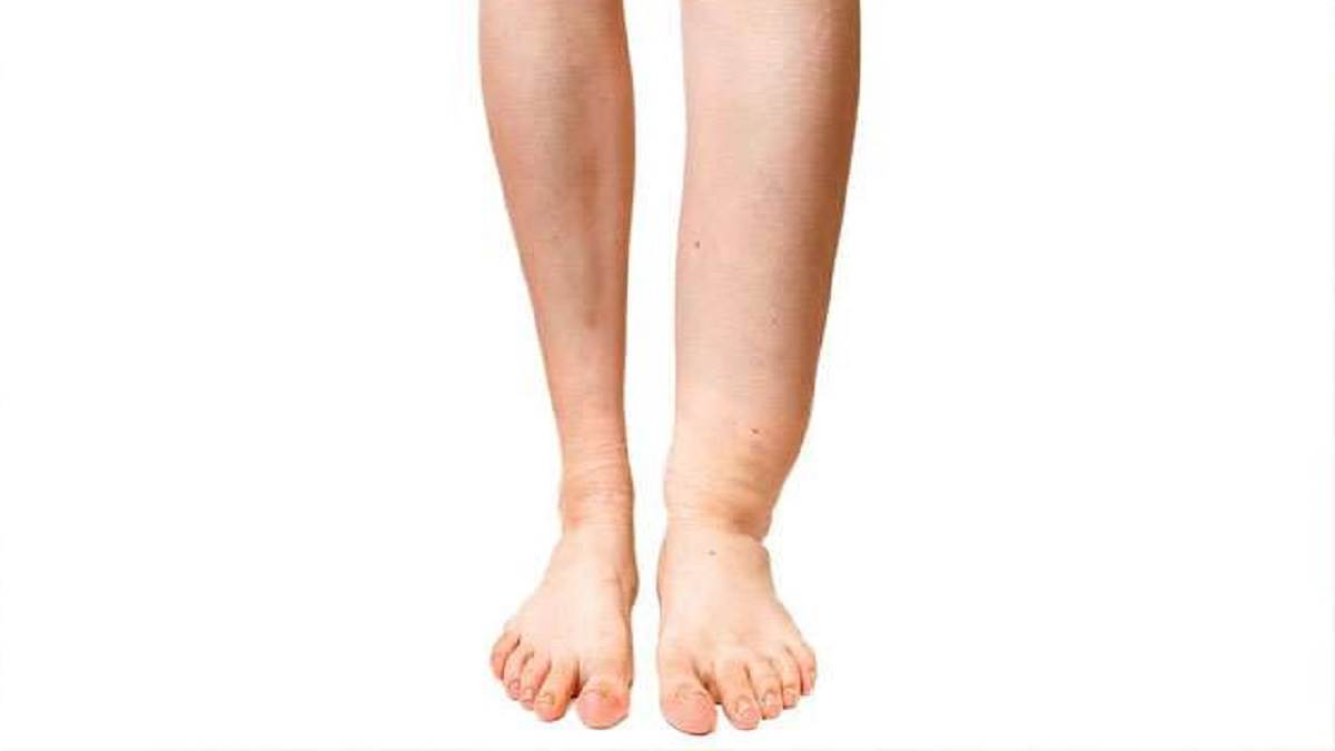 Filariasis: यूपी में फाइलेरिया उन्मूलन अभियान से जुड़ेंगे 13,700 हेल्थ ...