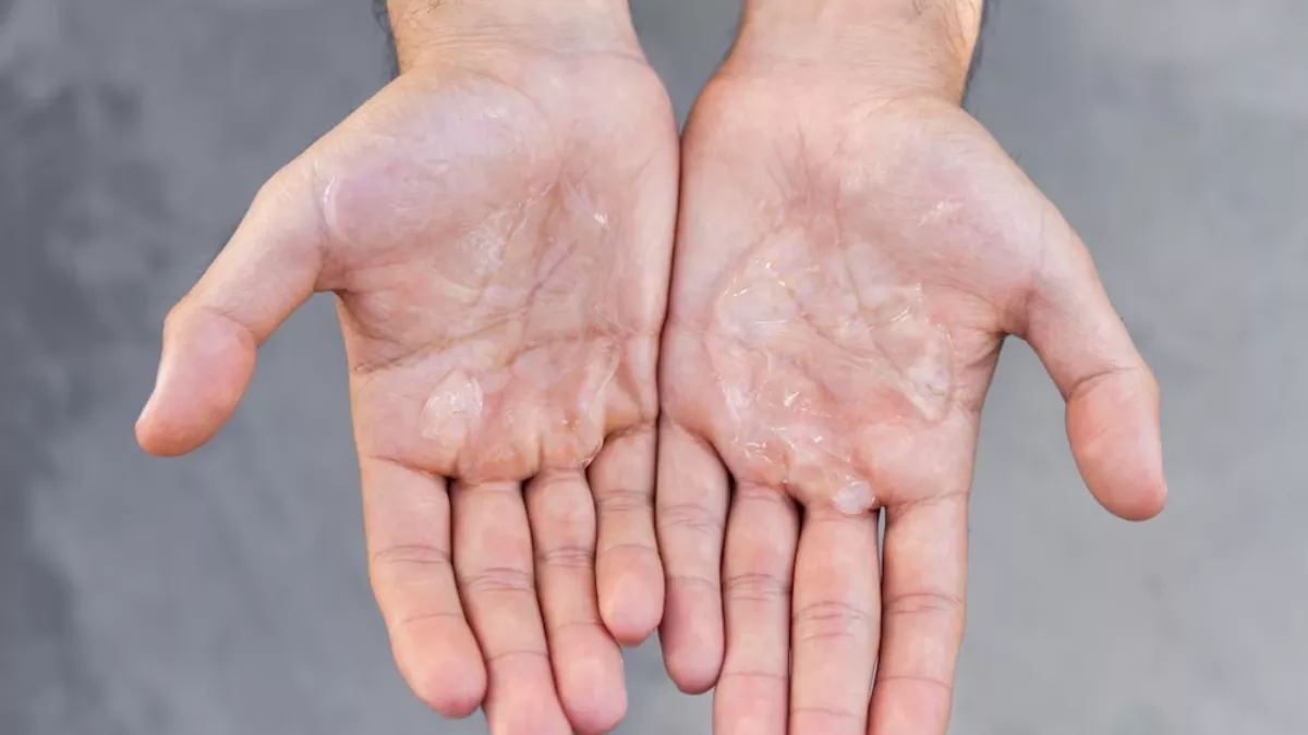 Dry Hands: बदलते मौसम में शुष्क हो रहे हैं आपके हाथ? जानें इसकी वजह और ...