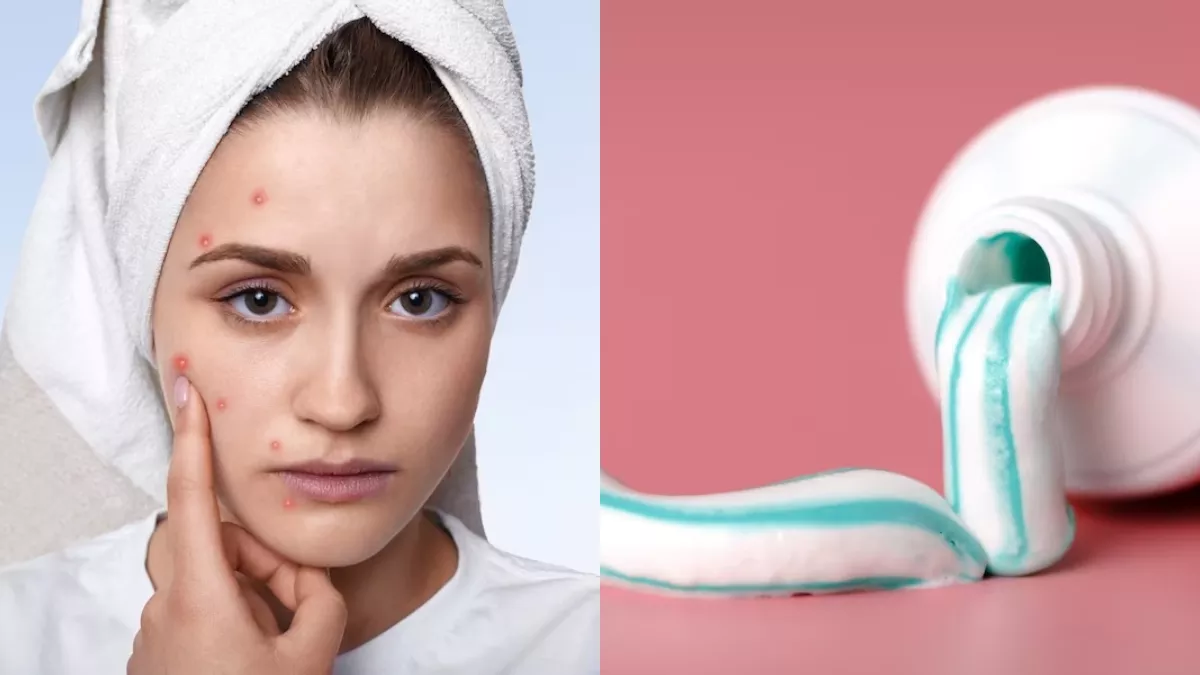 Toothpaste For Skin पिंपल से तुरंत राहत पाने के लिए अपनाते हैं टूथपेस्ट हैक तो जान लीजिए इसके