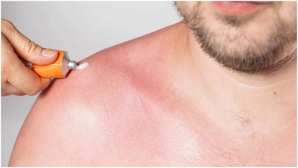 Winter Sunburn: नई स्टडी में खुलासा, सनबर्न से आपकी स्किन को बचा सकता ...