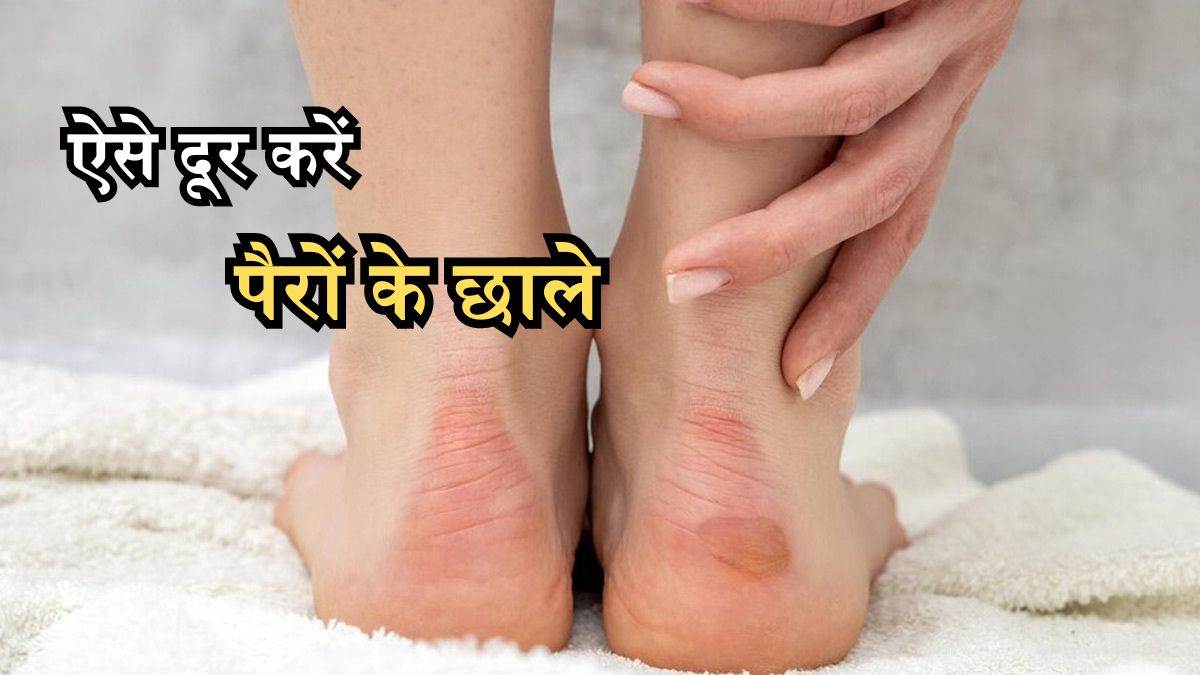 Shoe Bite Remedies: नए जूते या चप्पल से आपके पैरों में भी पड़ जाते हैं ...