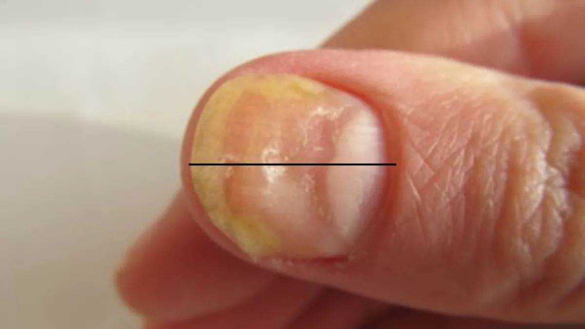 Yellow Nail Syndrome: पीले नाखून देते हैं शरीर में हो रही कुछ बीमारियों ...