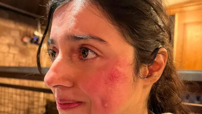 शूटिंग के दौरान घायल हुई Divya Khosla Kumar, तस्वीर शेयर कर दिखाया चेहरे का हाल - Divya Khosla ...