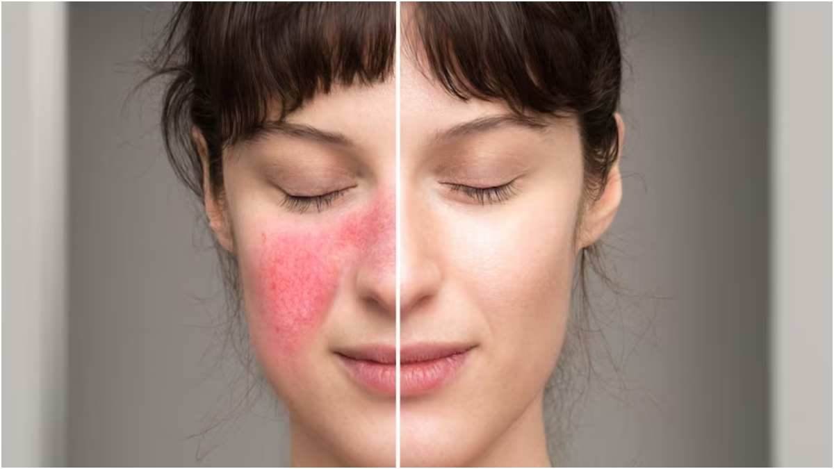 Face Redness Remedies: गर्मी से हो जाता है चेहरा लाल, तो राहत देंगे ये ...