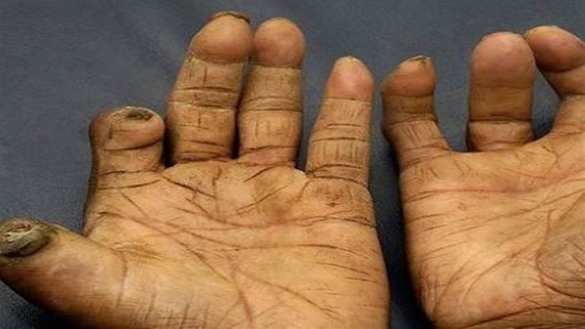 छत्‍तीसगढ़ में तेजी से फैल रहा है कुष्‍ठ रोग, कुछ की हालत इलाज के लायक ...