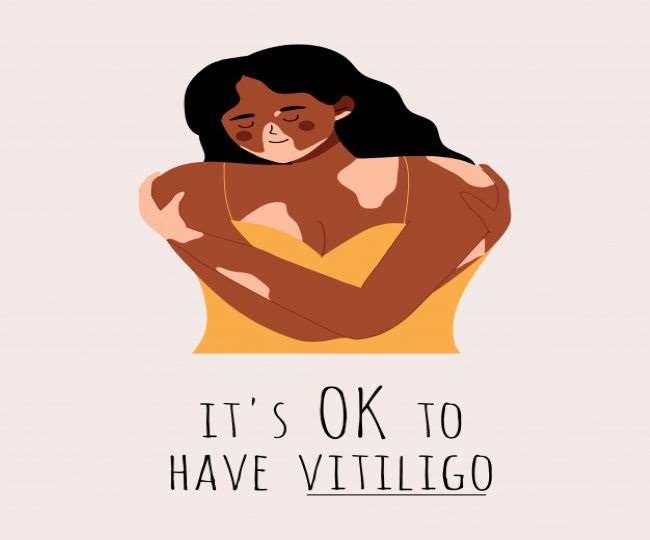 World Vitiligo Day 2021: सफेद दाग नहीं है छुआछूत की बीमारी, भ्रांतियों ...