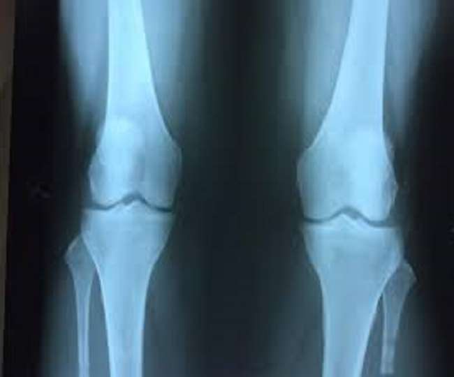 हल्‍द्वानी में बिना ऑपरेशन के पीएफओ विधि से घुटने का सफल ऑपरेशन ...