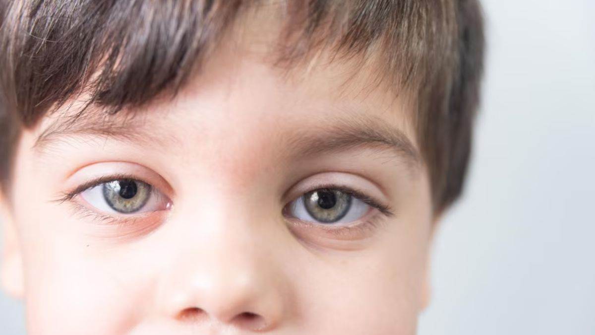 Squint Eyes In Children: बच्चे की आंखें हैं तिरछी, तो काम आएंगे ये उपाय ...