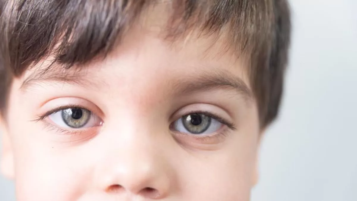 Squint Eyes In Children: बच्चे की आंखें हैं तिरछी, तो काम आएंगे ये उपाय ...