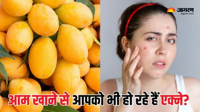 क्या आम खाने से सच में हो जाता है एक्ने? एक्सपर्ट ने दिया इस सवाल का ...