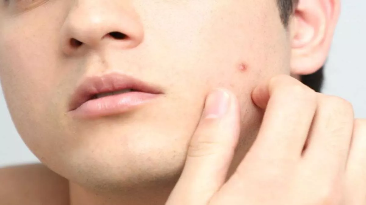 मुंहासे के इलाज में ली जाने वाली एंटीबायोटिक्स दवाओं को लेकर रहें सतर्क ...
