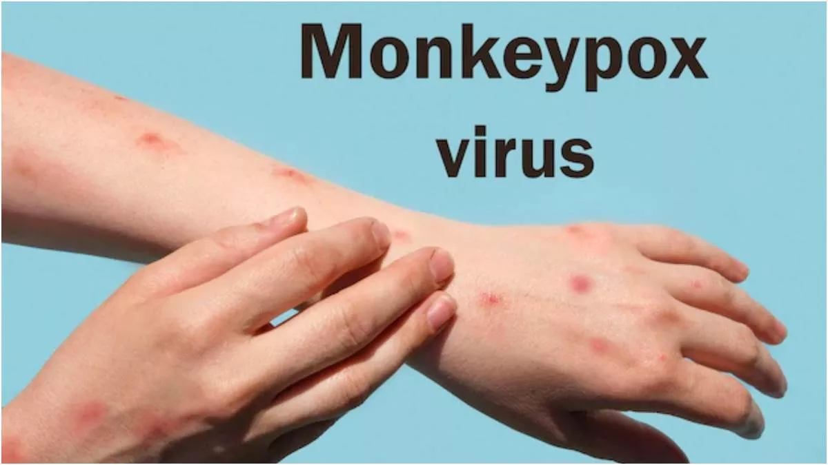 Monkeypox Virus: मंकीपाक्स की आहट, चेहरे पर निकल रहे दाने, प्रयागराज ...