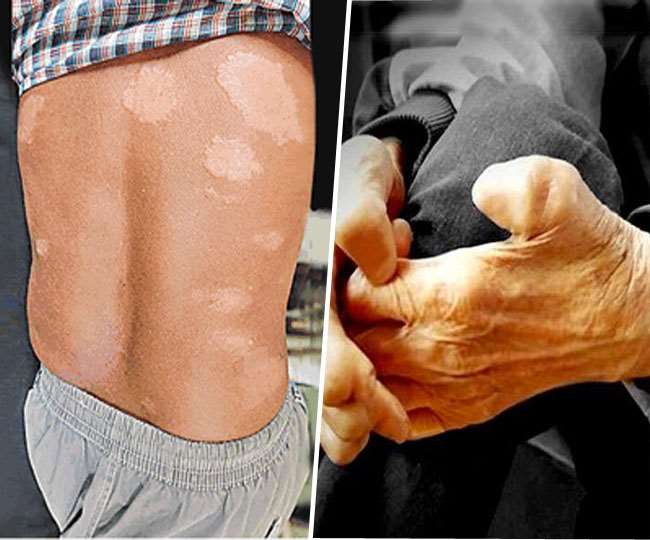 Leprosy Free India Campaign: आजादी के समय अभिशप्त कहे जाने वाले कुष्ठ ...