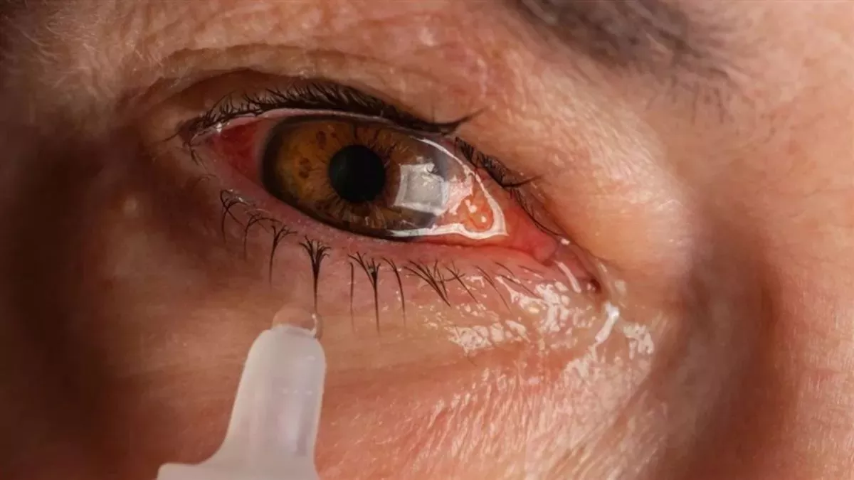 Eye Flu In UP: यूपी में तेजी से बढ़े कंजक्टिवाइटिस के मरीज, गर्मी और ...
