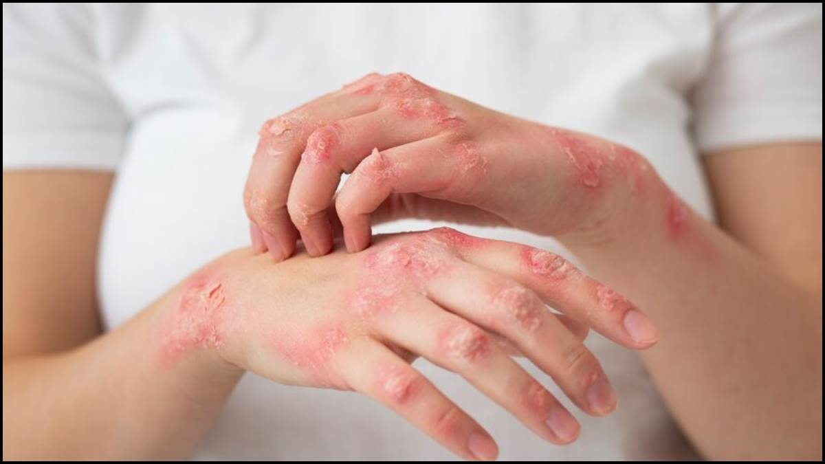 World Leprosy Day 2023: समय से इलाज न मिलने पर गंभीर रूप ले सकता है ...