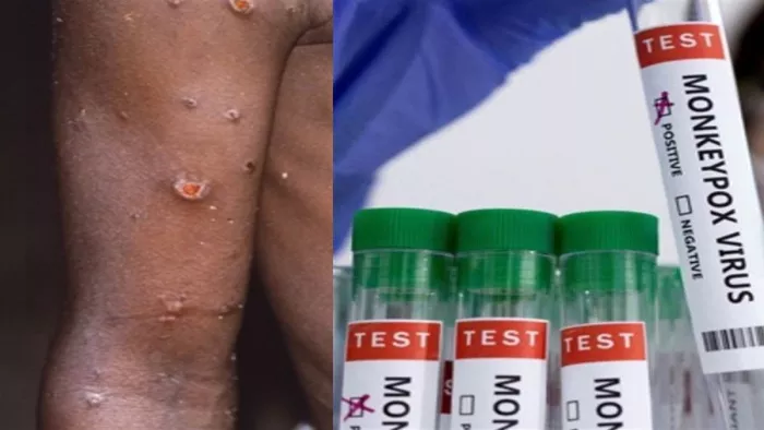 Monkeypox: अध्ययन में चला पता- मंकीपॉक्स के इलाज के लिए एंटीवायरल ...