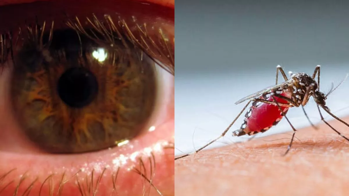 Eye Flu Dengue Attack: कानपुर में कंजक्टिवाइटिस के साथ डेंगू का हमला ...