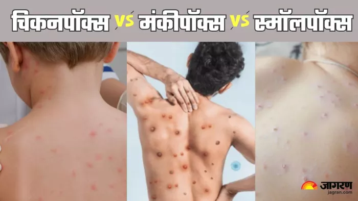 एक-दूसरे से कितने अलग हैं Chickenpox, Smallpox और Mpox, डॉक्टर ने बताया ...