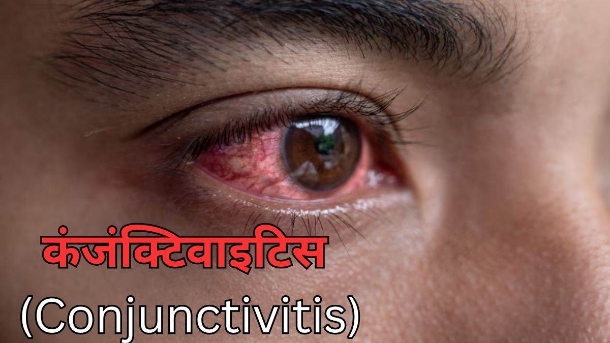 कंजंक्टिवाइटिस Conjunctivitis - what is conjunctivitis know pink eye or eye flu symptoms causes ...