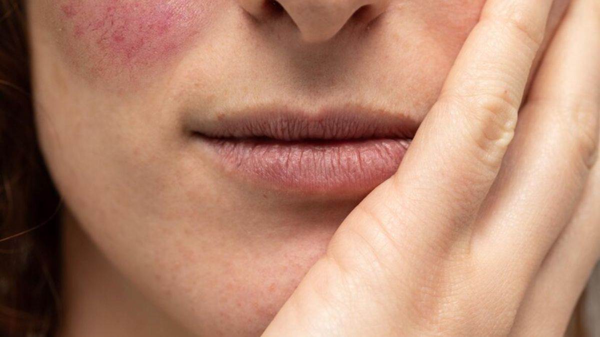 Winter Skin Care: सर्द हवाओं की वजह से रूखे हो गए हैं गाल, तो अपनाएं ये ...