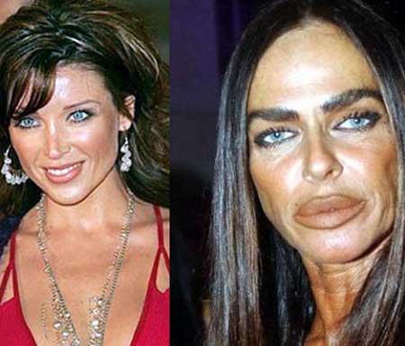Plastic Surgery Disasters Of The World, Photo Gallery Inext Live